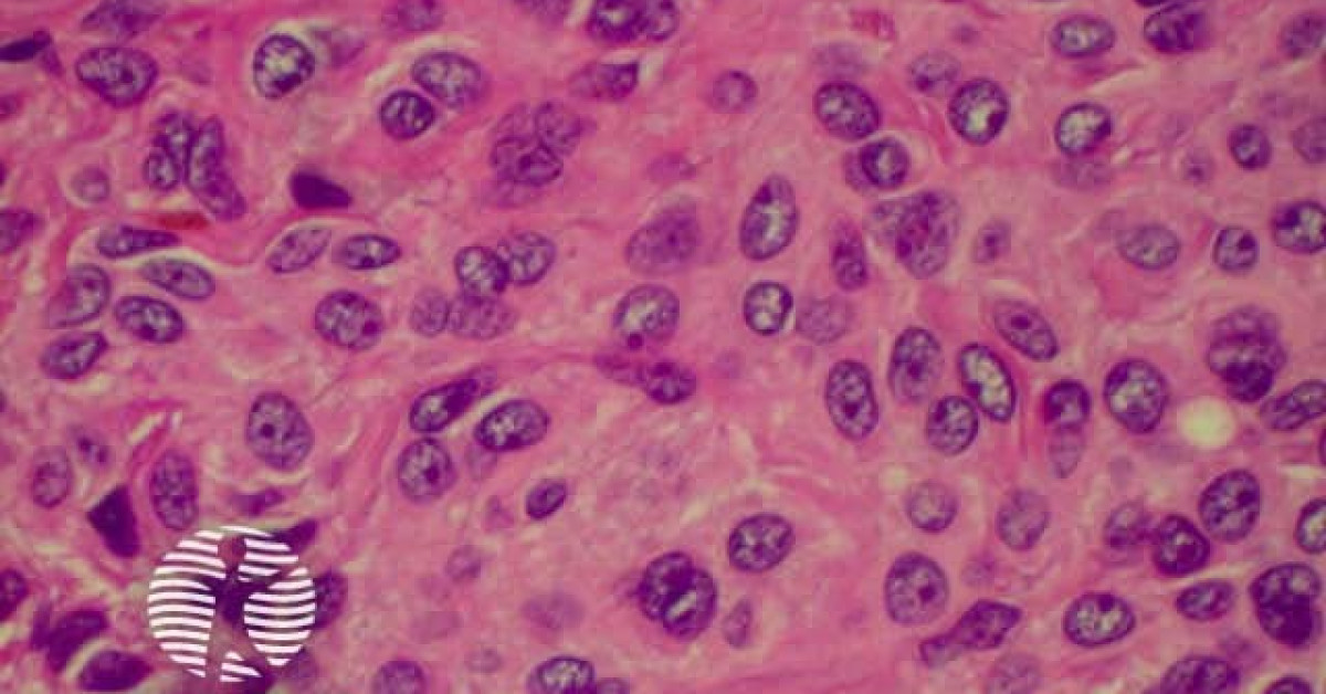 Pathology of superficial naevus image