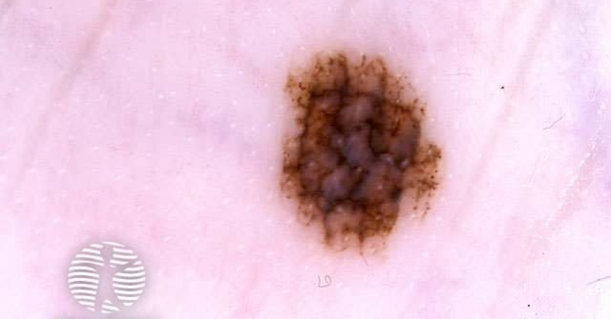 Dermoscopy using ABCD algorithm image