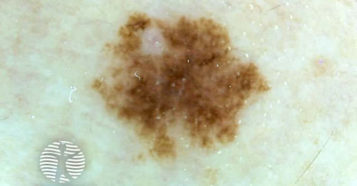 Dermoscopy using ABCD algorithm image