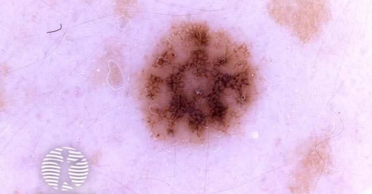Dermoscopy of melanocytic naevus image