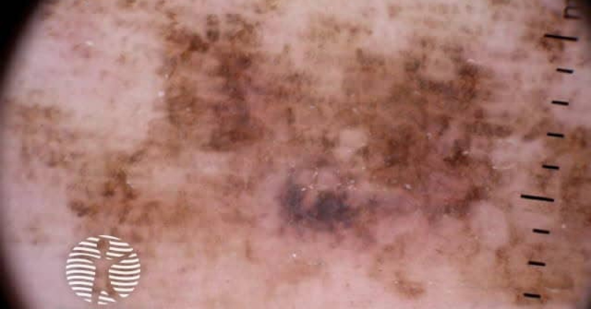 Dermoscopy of acral melanoma image