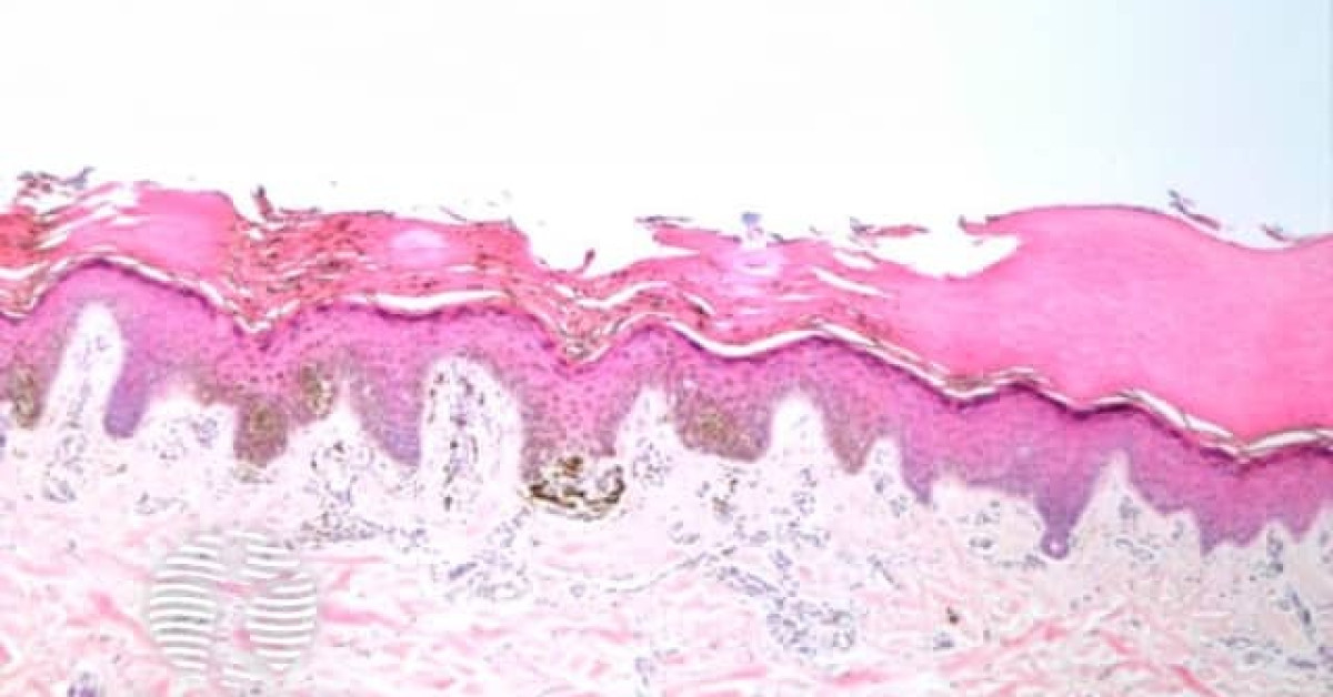 Histology of acral melanocytic naevus image