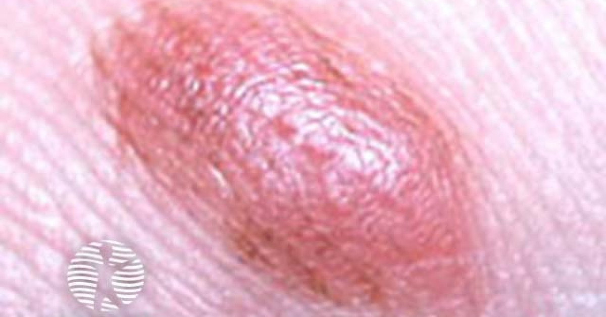 Acral naevus clinical image