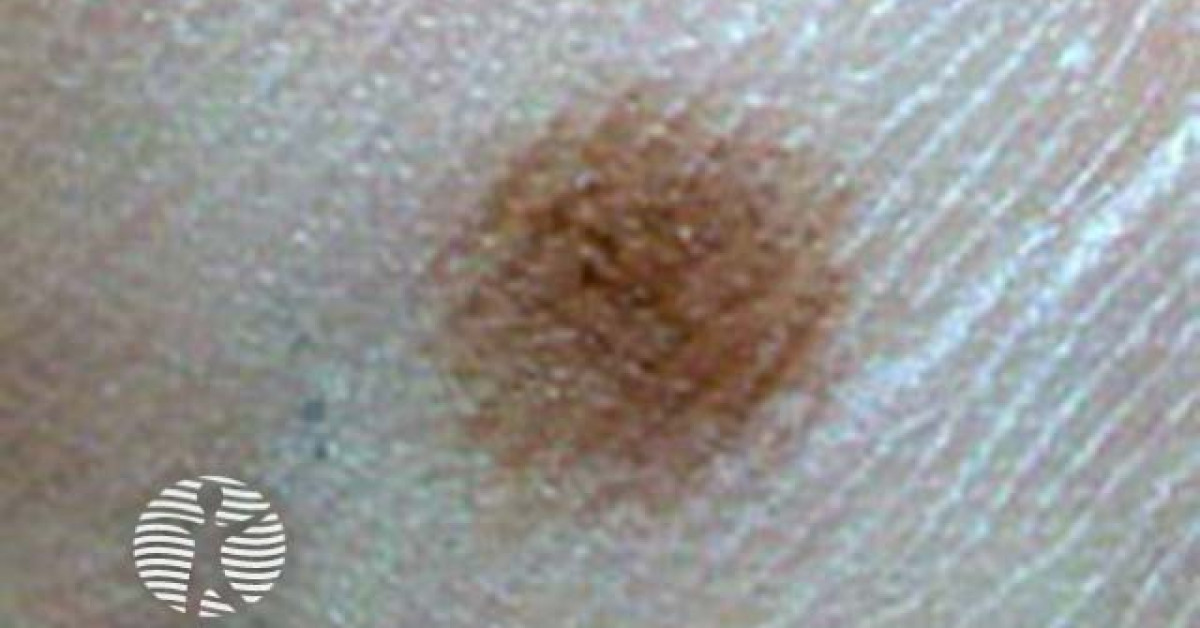 acral naevus clinical image