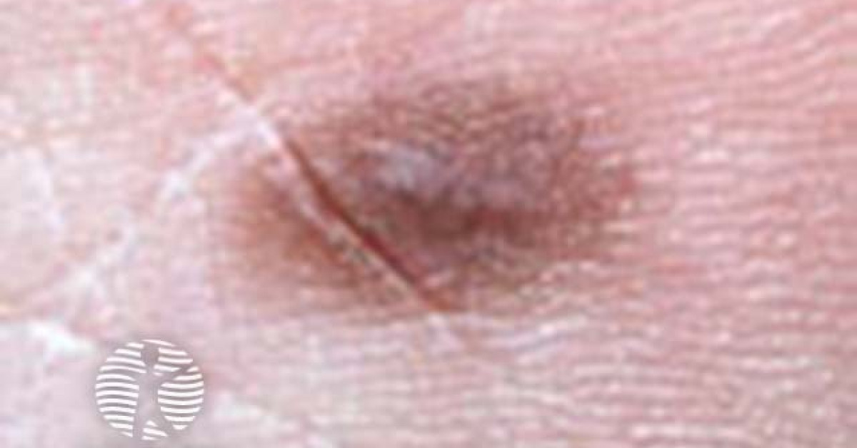 acral naevus clinical image