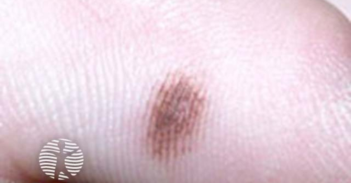 acral naevus clinical image