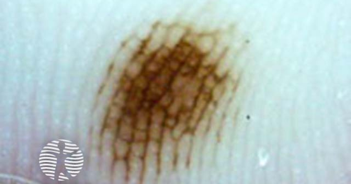 acral naevus dermoscopy image