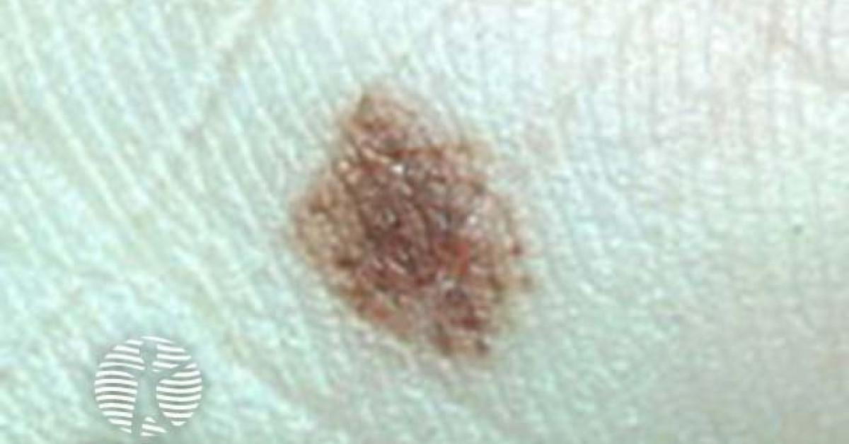 acral naevus clinical image