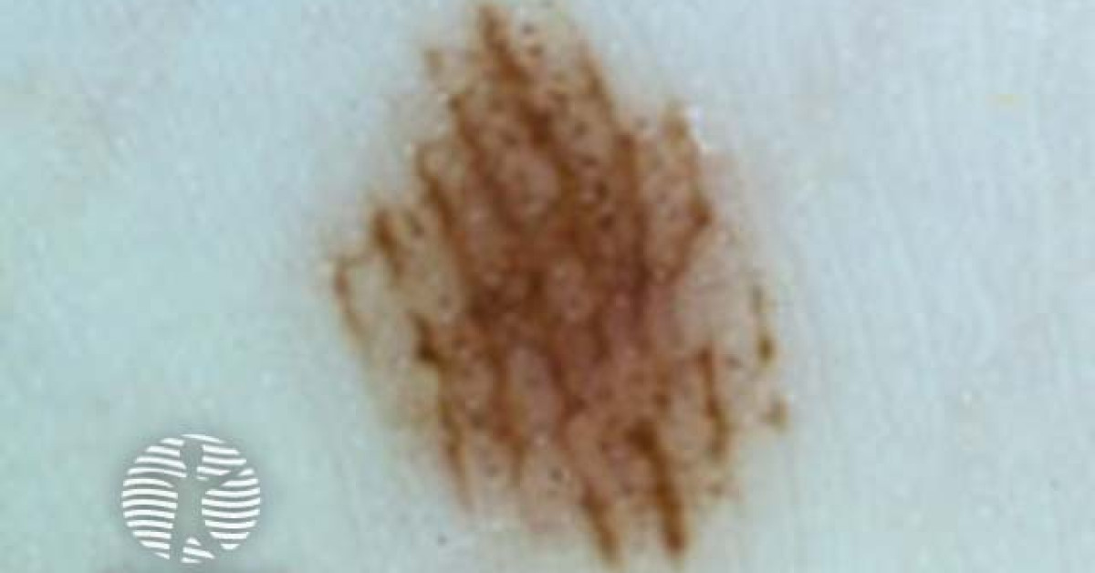 acral naevus dermoscopy image