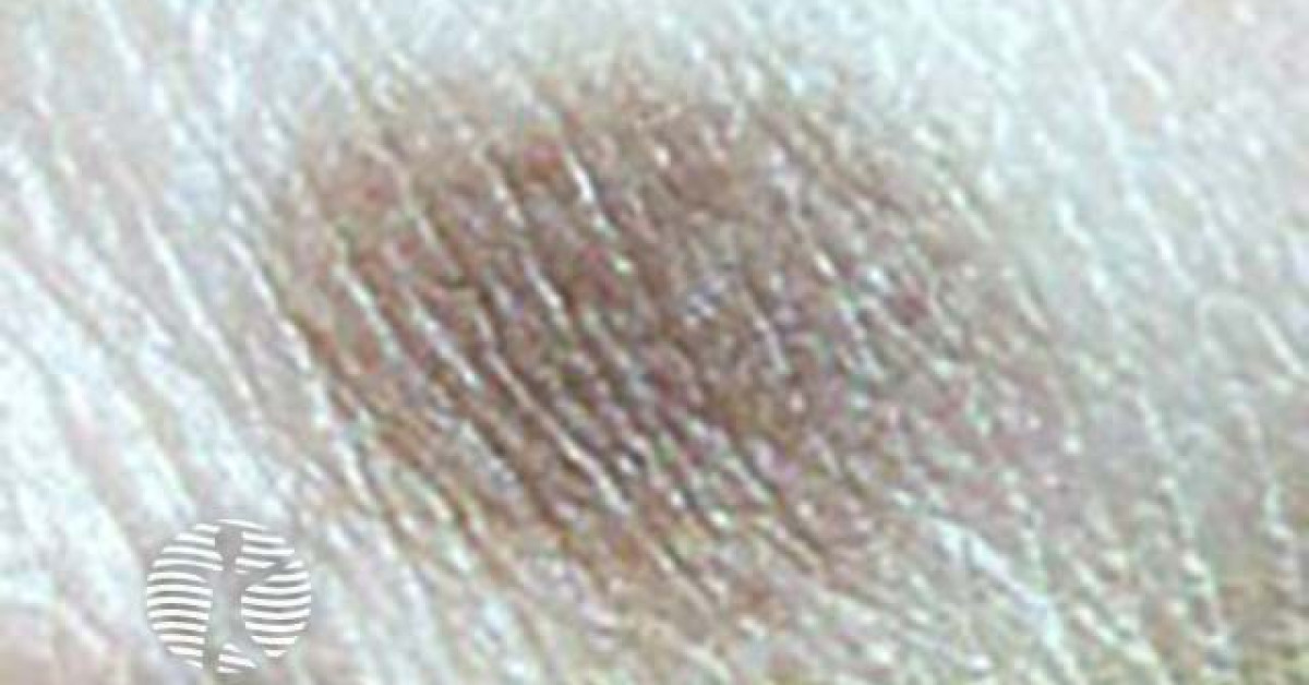 acral naevus clinical image