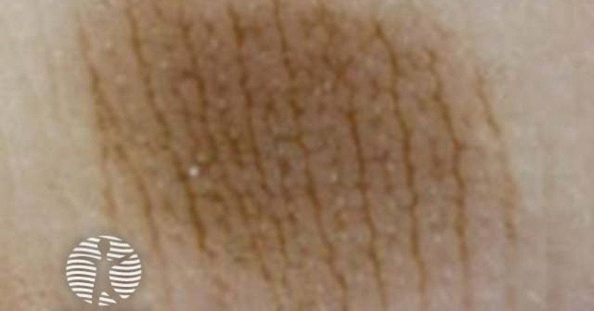 acral naevus dermoscopy image