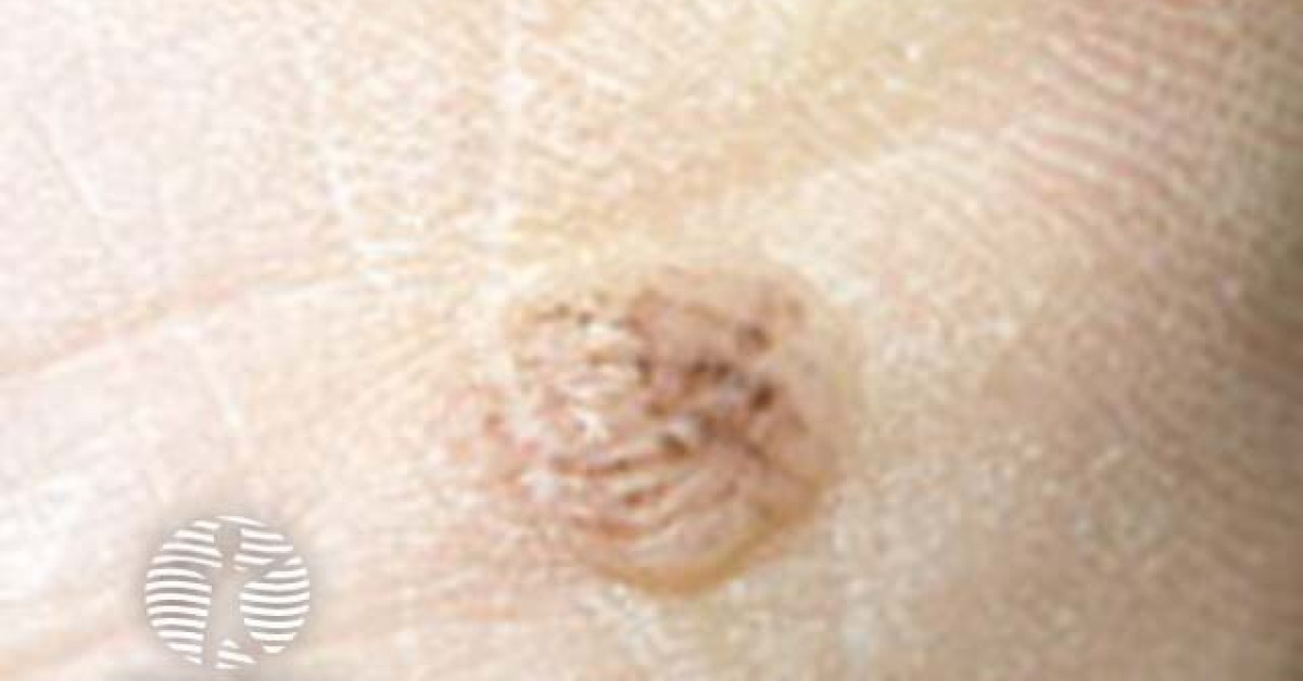 acral naevus clinical image