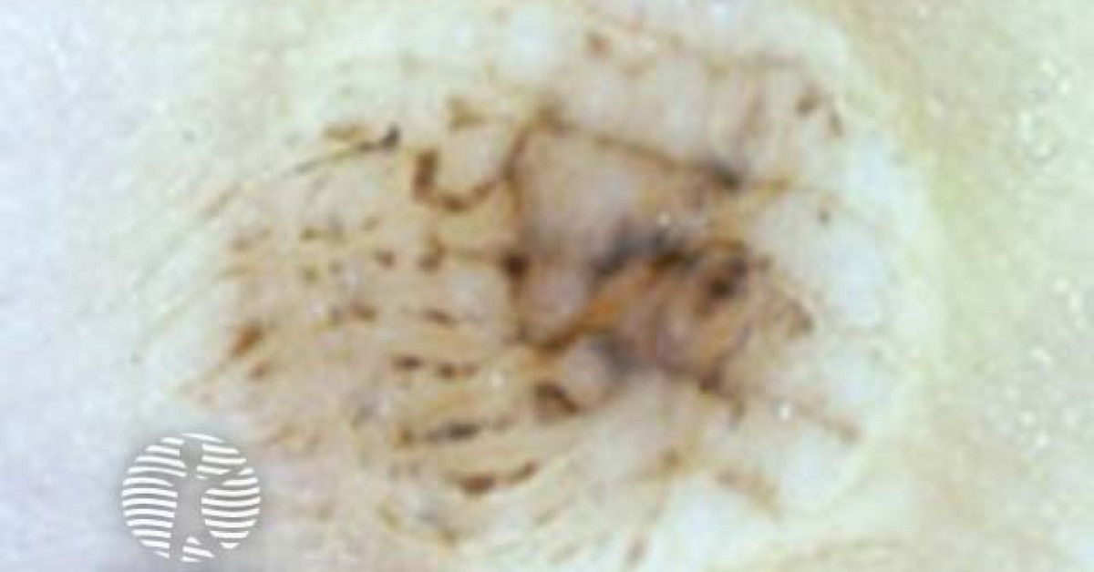 acral naevus dermoscopy image