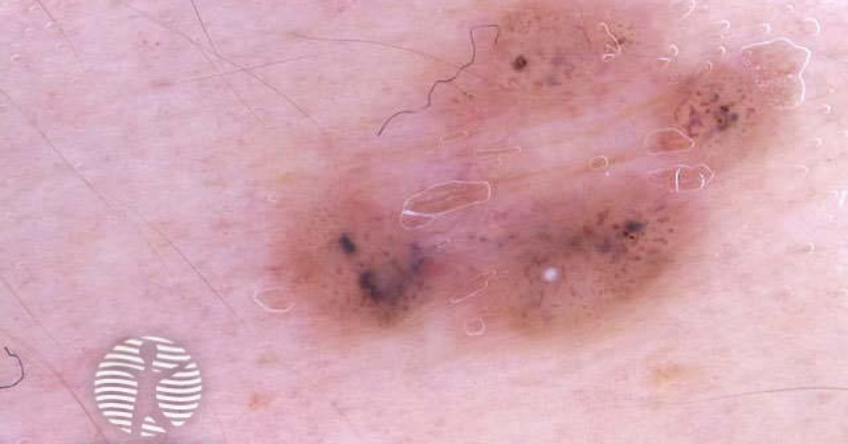 Dermoscopy image