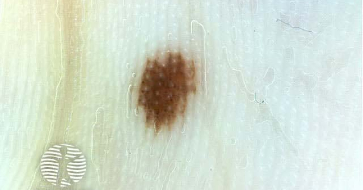 Dermoscopy. Parallel diffuse pattern. Acral naevus image