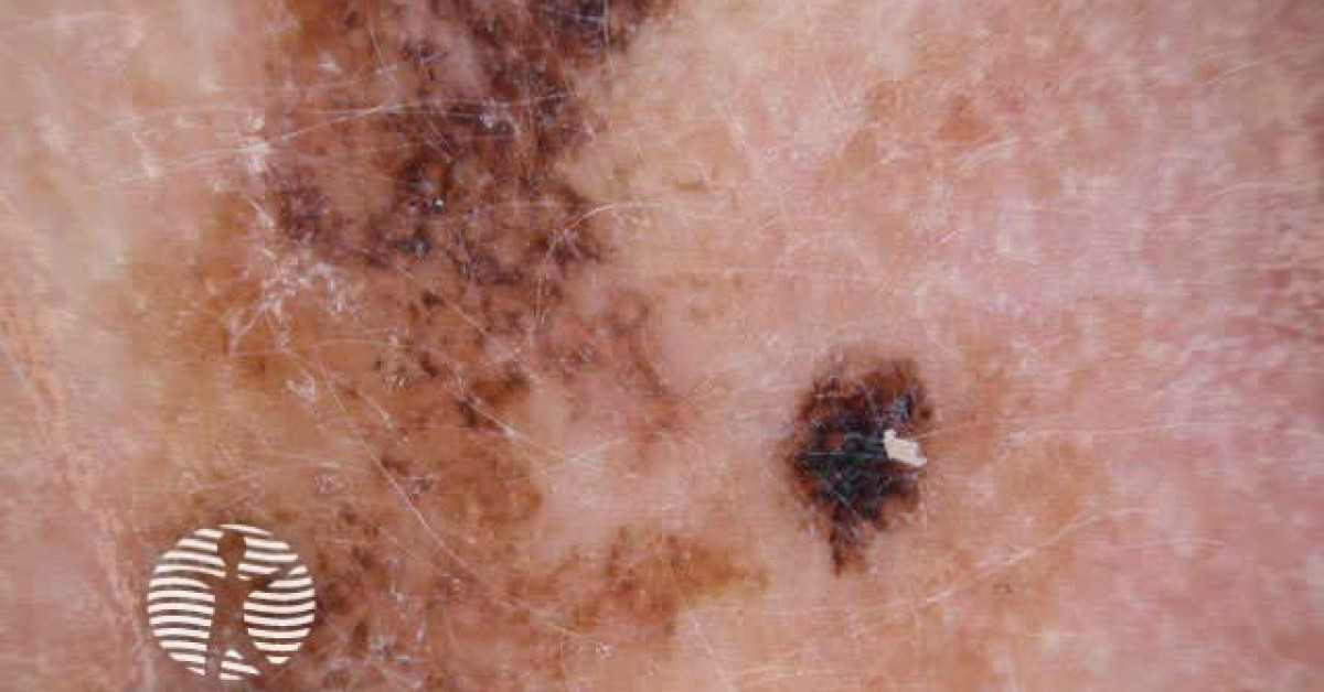 Dermoscopy. Melanoma on the face image