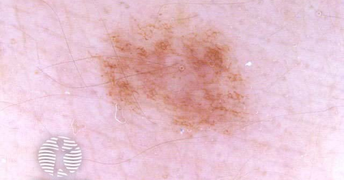 Dermoscopy. Fading pigment network. Naevus image