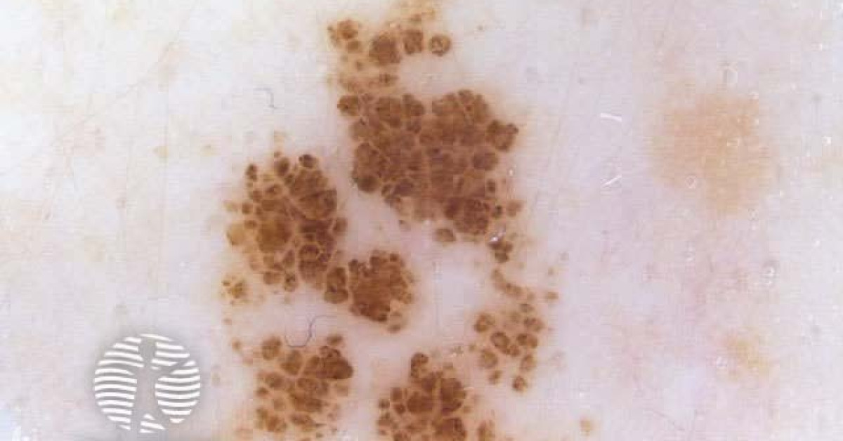 Dermoscopy. Regular globules. Naevus image