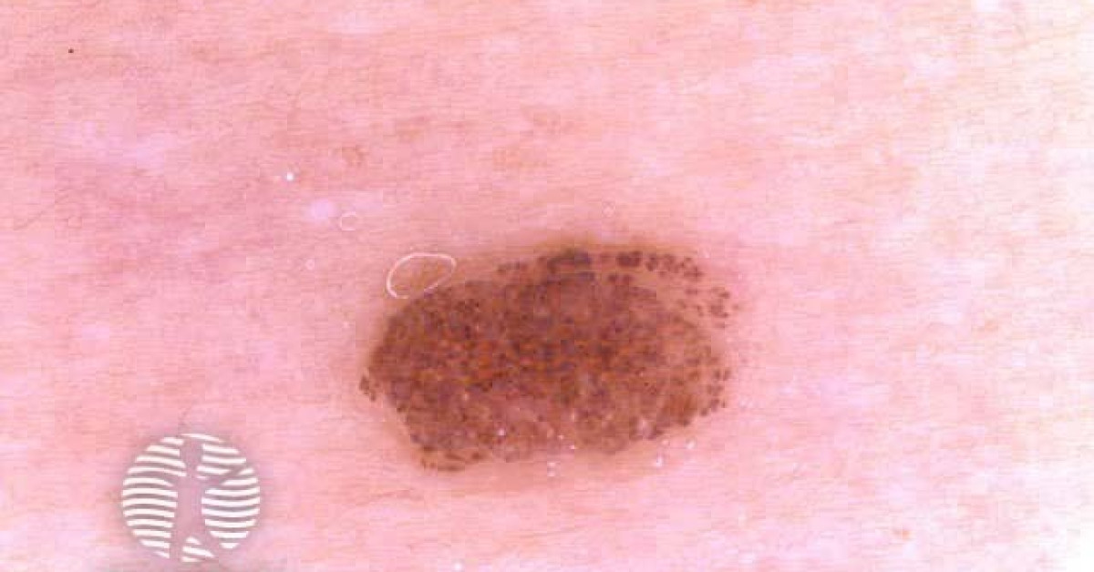 Dermoscopy. Globular pattern. Naevus image