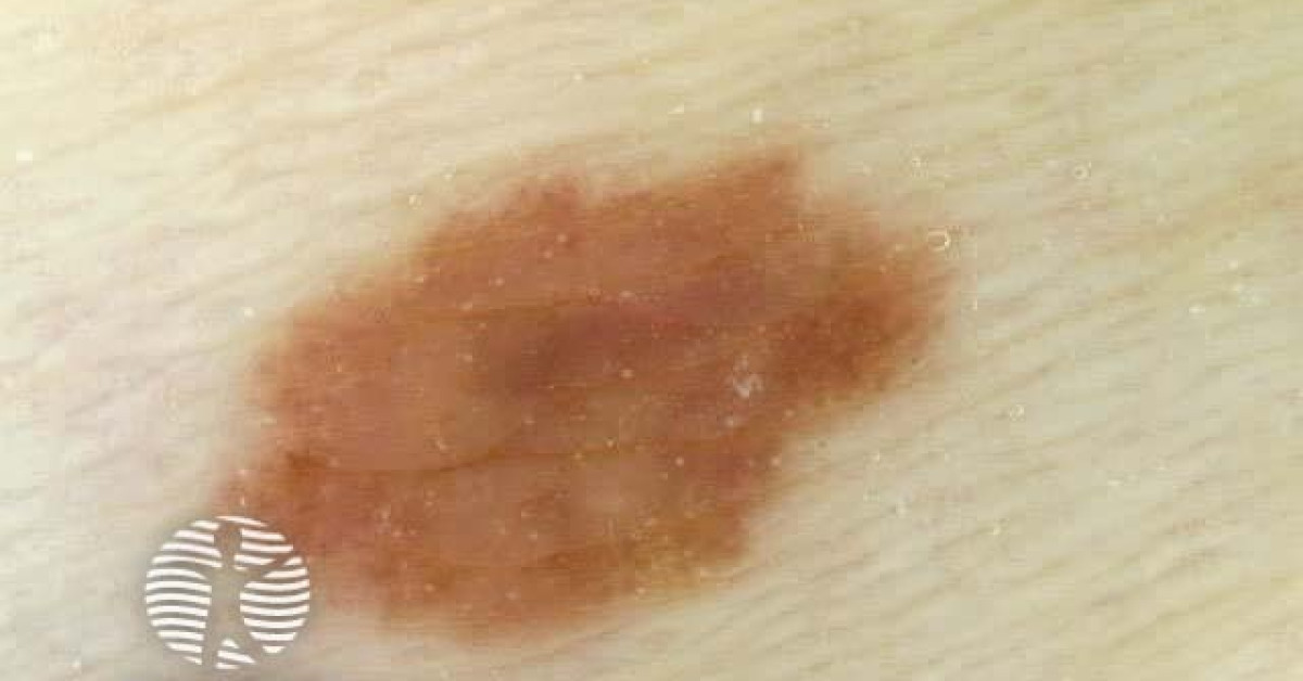 Dermoscopy.Dermoscopy of melanocytic naevus. ABCD algorithm image