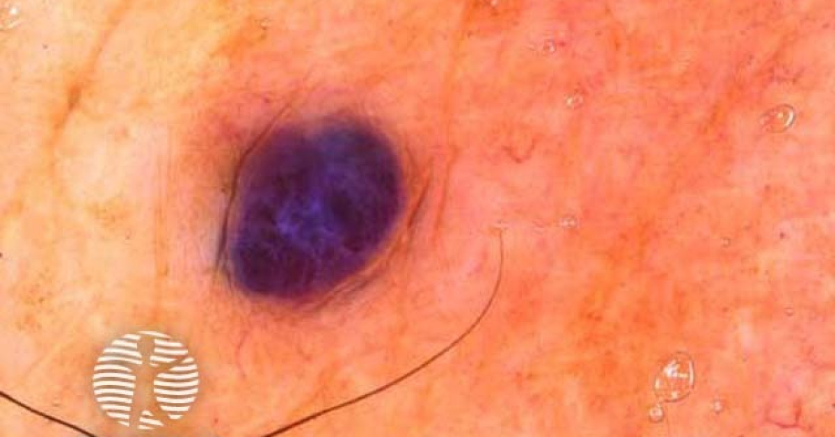 DermNet® - Dermoscopy image