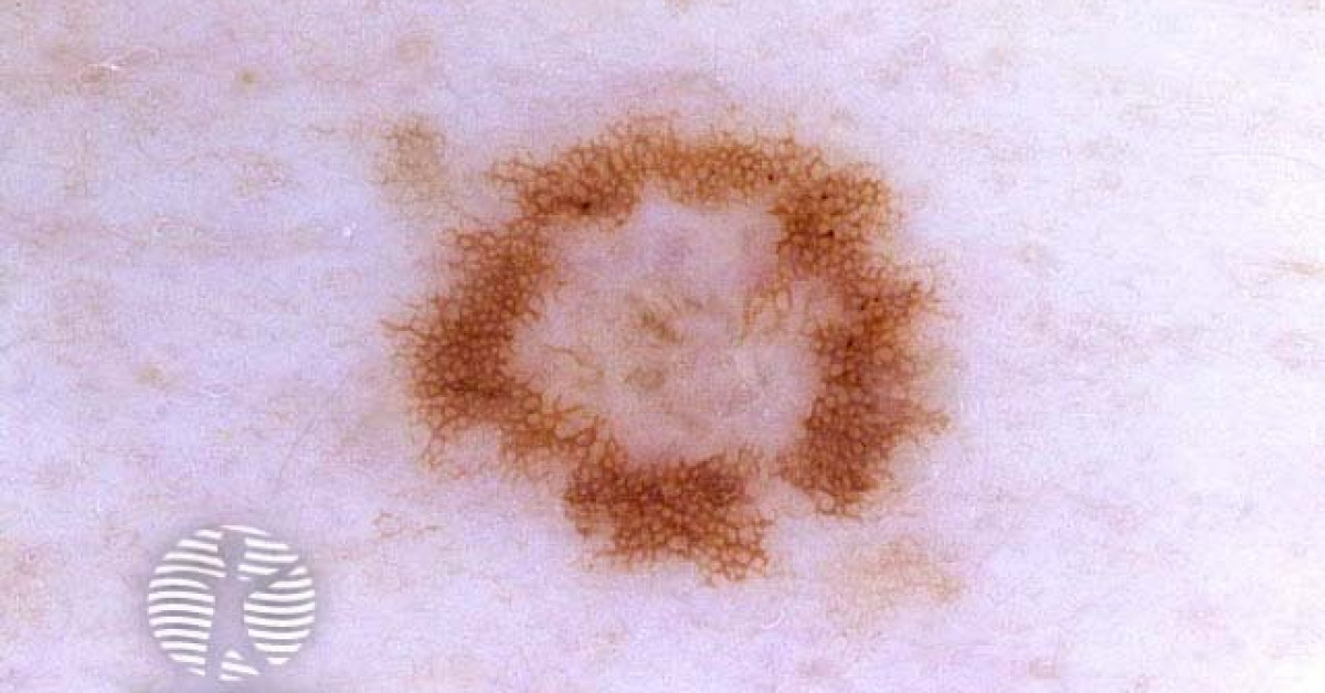 Dermoscopy. Central hypopigmentation. Naevus image