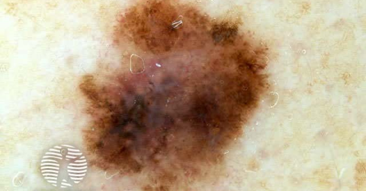 Dermoscopy. Multicomponent pattern. Melanoma image