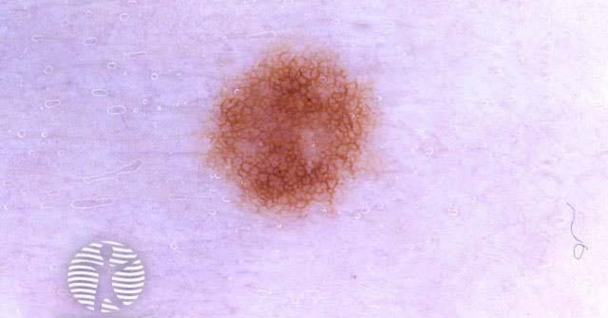 Dermoscopy. Reticular pattern. Naevus image