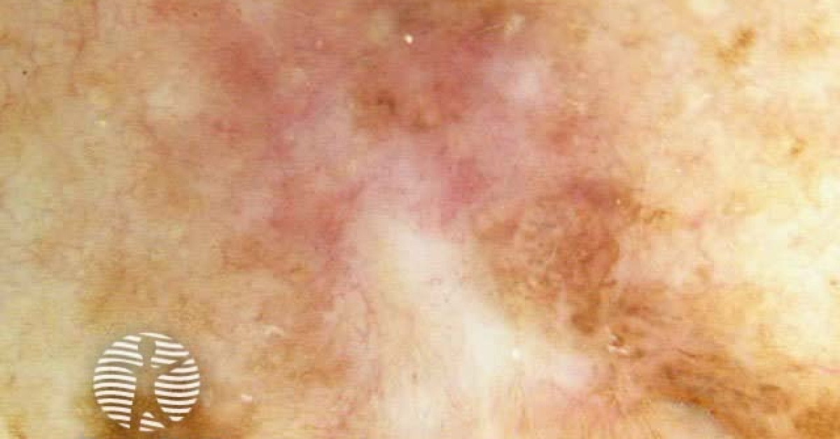 Dermoscopy. Scar-like depigmentation. Melanoma image