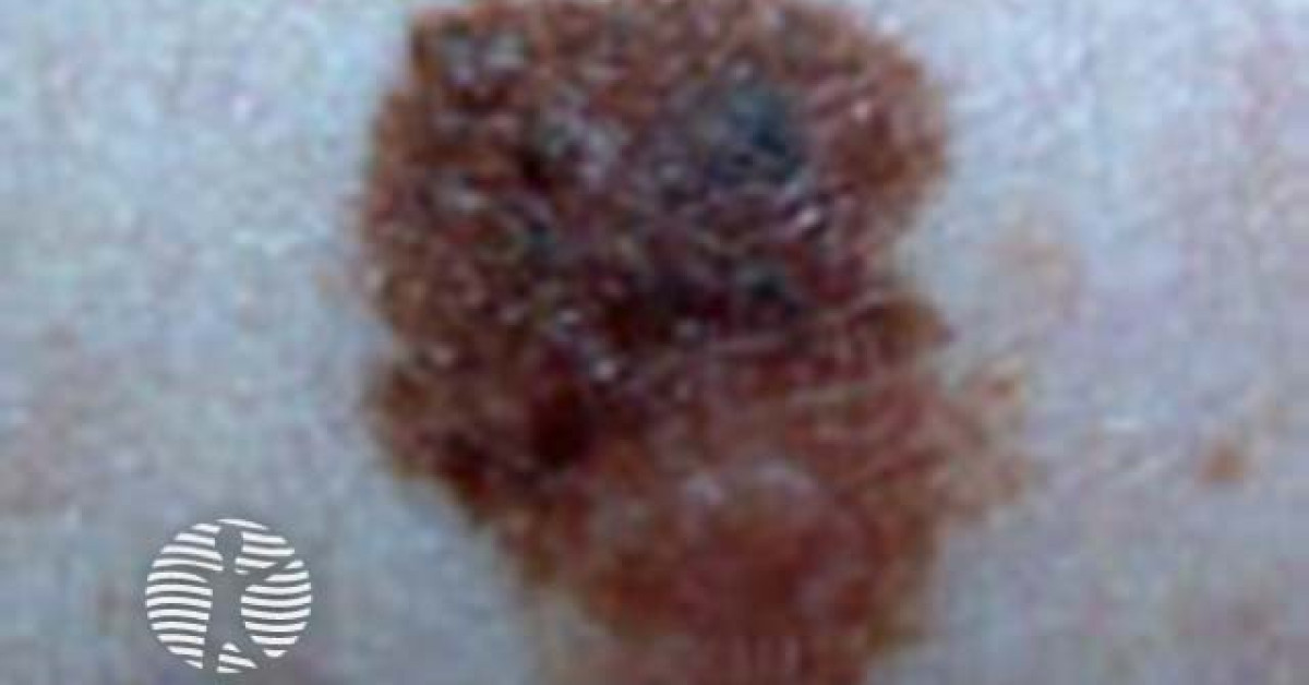 atypical naevus clinical image