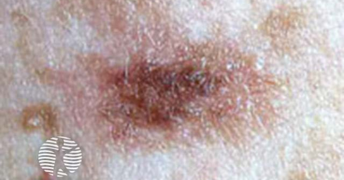 atypical naevus clinical image