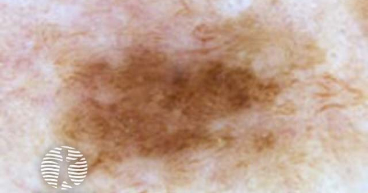 atypical naevus dermoscopy image