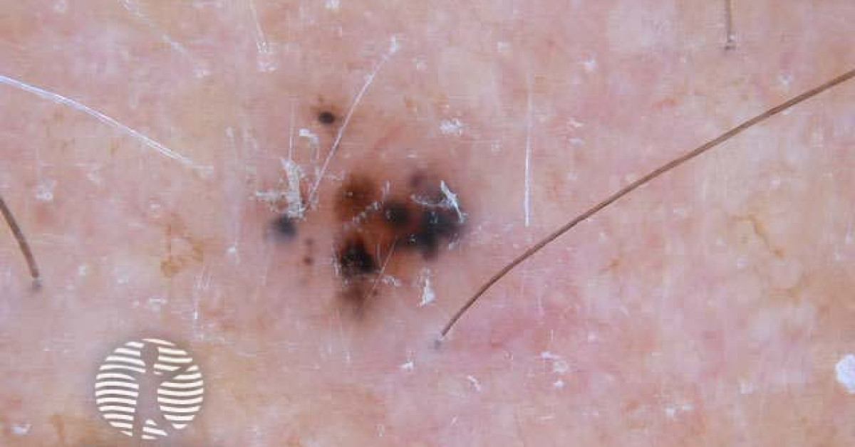 Pigmented BCC dermoscopy image