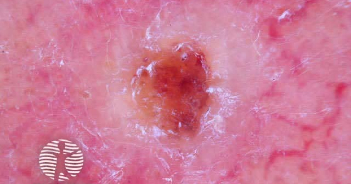 Nonpigmented basal cell carcinoma dermoscopy image