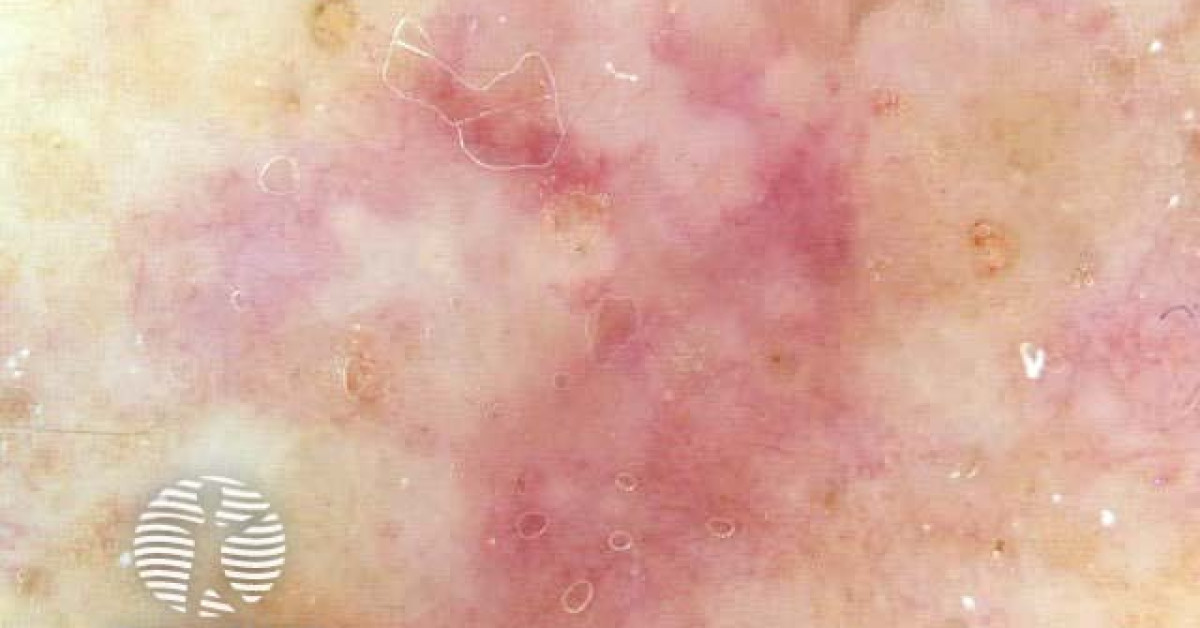 Nonpigmented basal cell carcinoma dermoscopy image