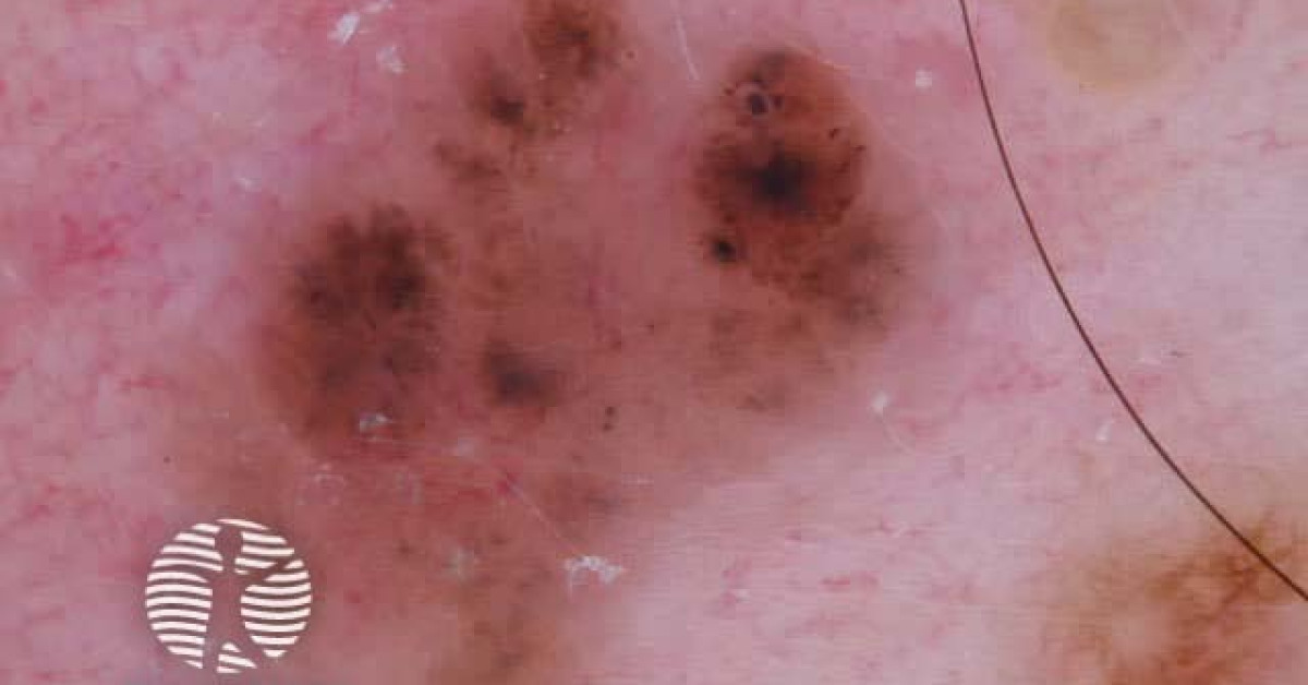 Pigmented basal cell carcinoma dermoscopy image