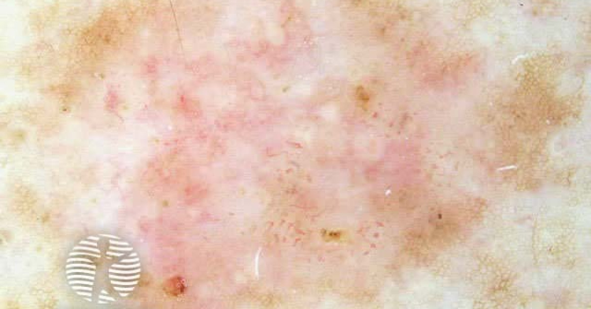 Nonpigmented basal cell carcinoma dermoscopy image
