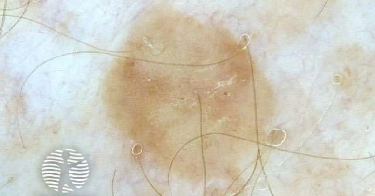 Seborrhoeic keratosis dermoscopy image