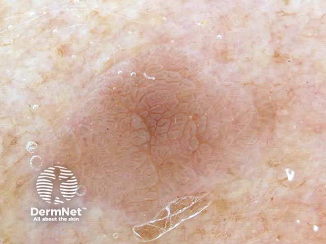 Seborrheic Keratosis Scalp Dermnet Seborrheic Keratosis Scalp Dermnet