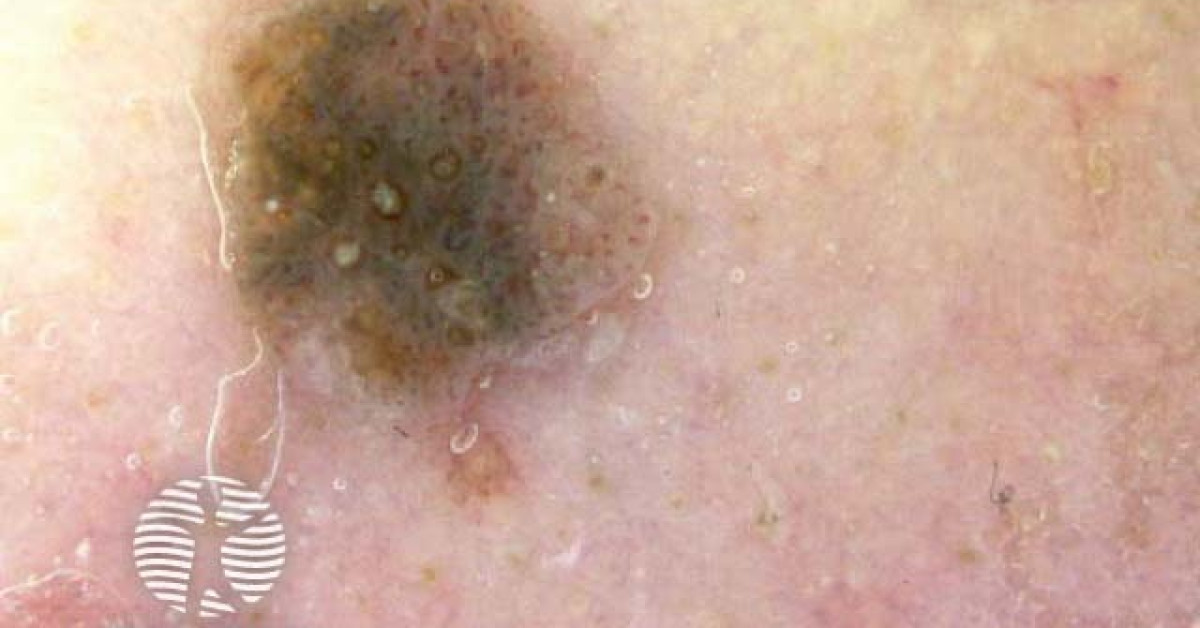 Seborrhoeic keratosis dermoscopy image