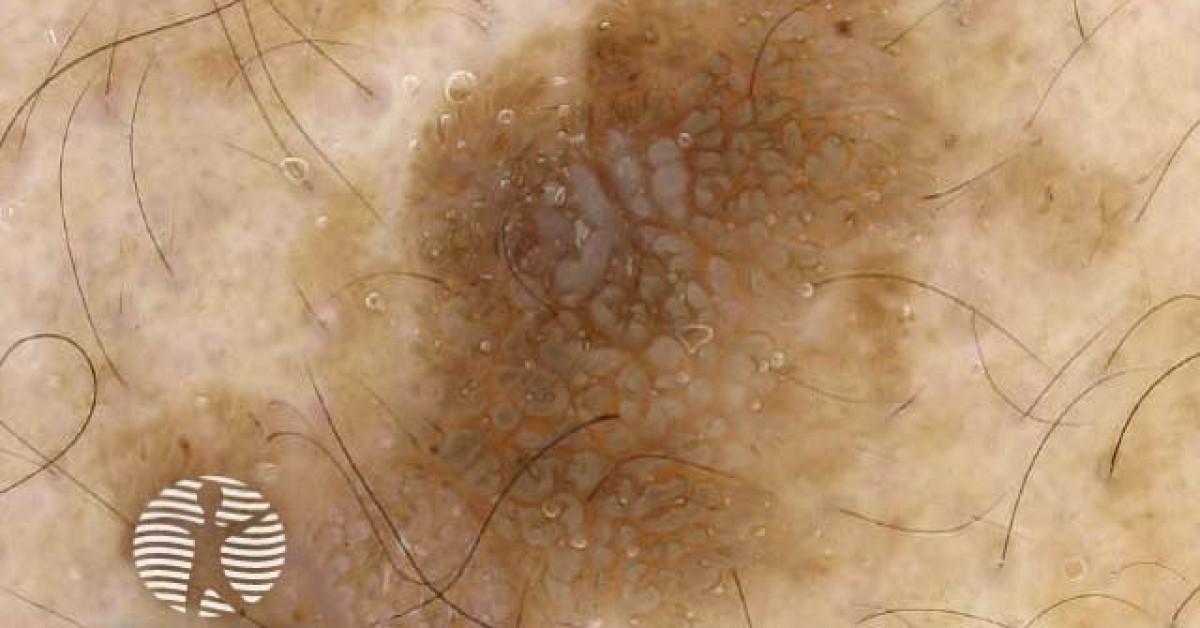 Seborrhoeic keratosis dermoscopy image