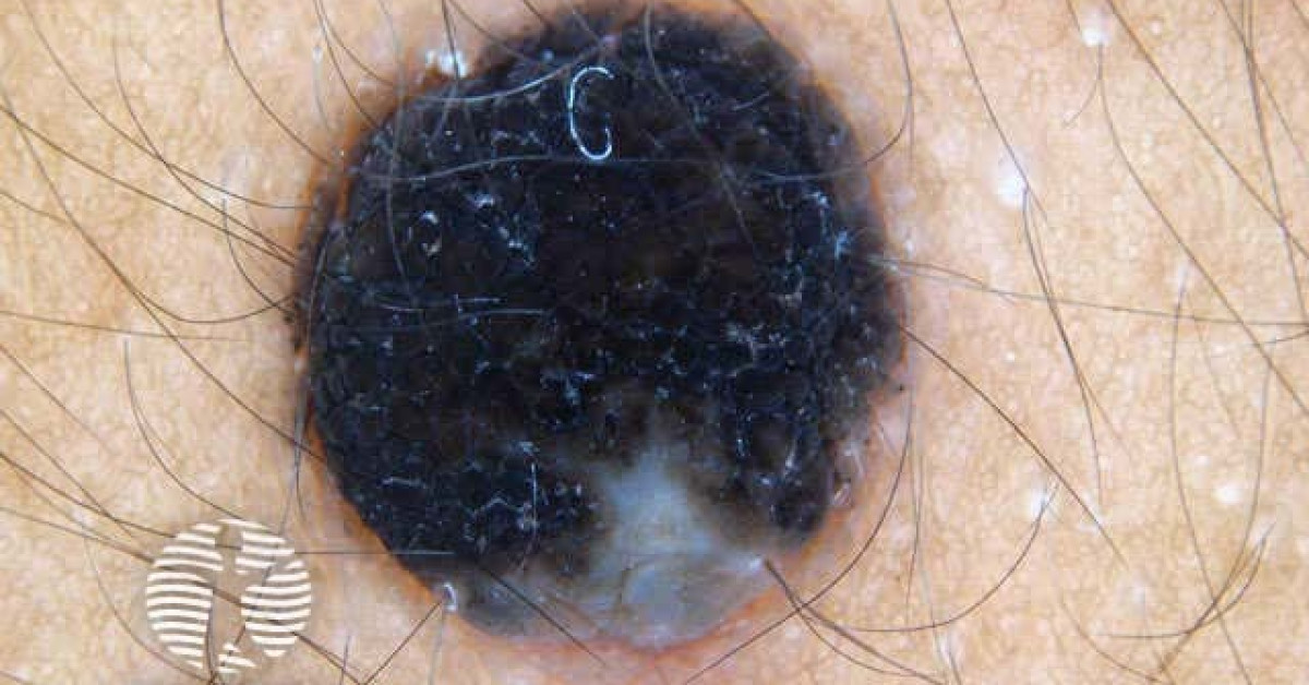 Melanocytic naevus image
