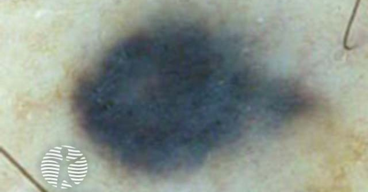 Blue naevus dermoscopy image