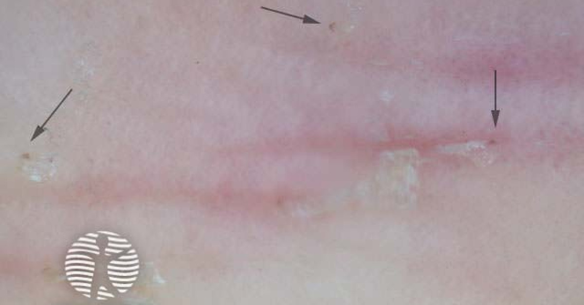 Dermoscopy of scabies image