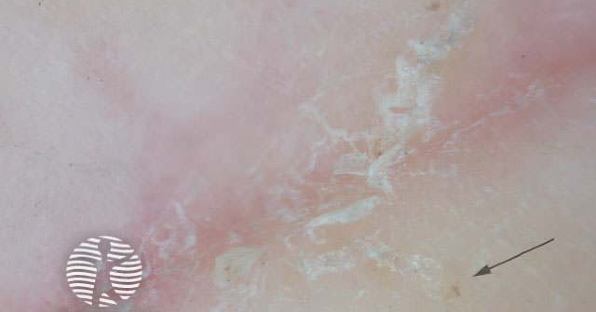 Dermoscopy of scabies image