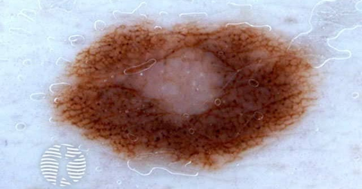 Atypical naevus image