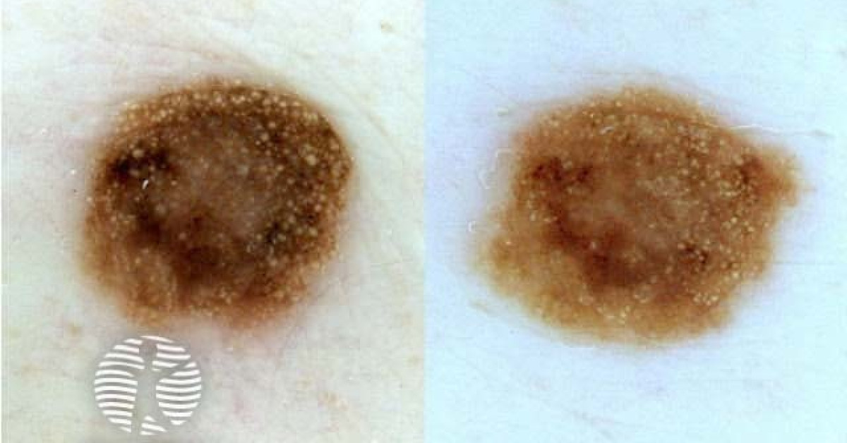 Melanocytic naevus image