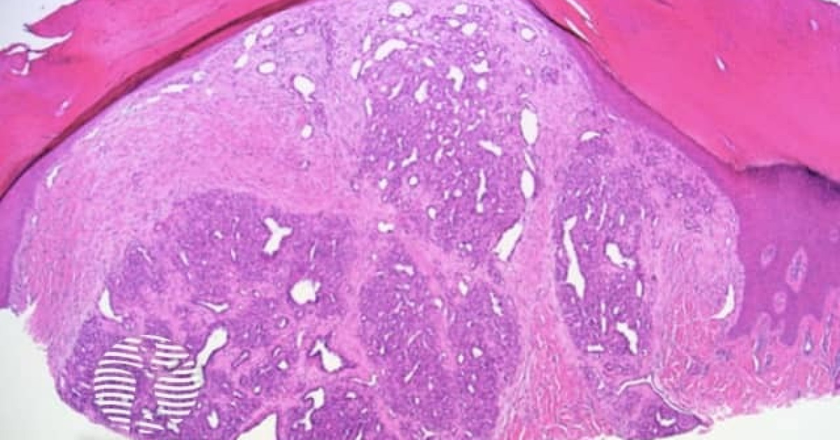 Histopathology of pyogenic granuloma image