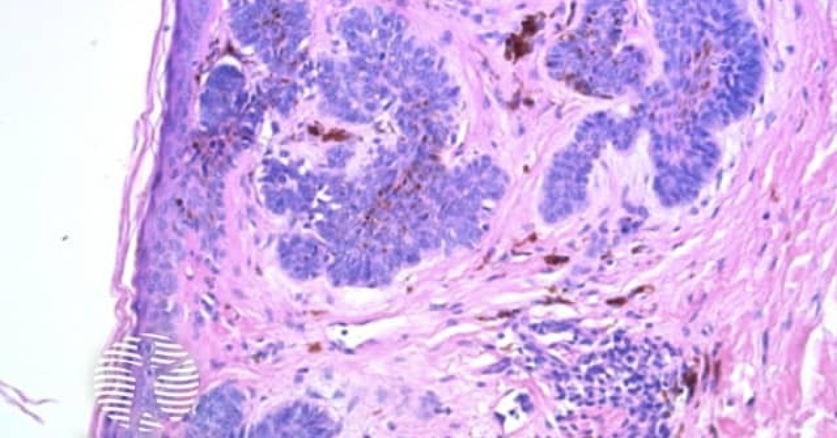 Histopathology of basal cell carcinoma image
