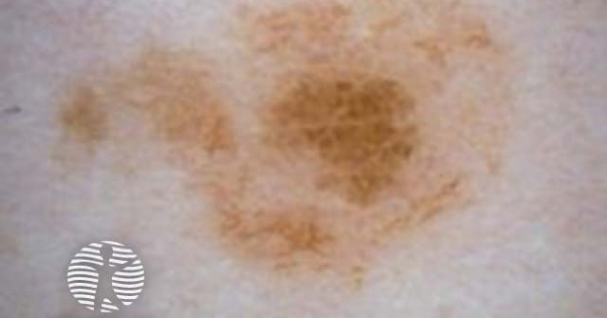 Cockade naevus dermoscopy image